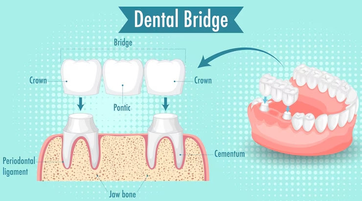 Are Bonded Bridges a Good Option for Missing Front Teeth?